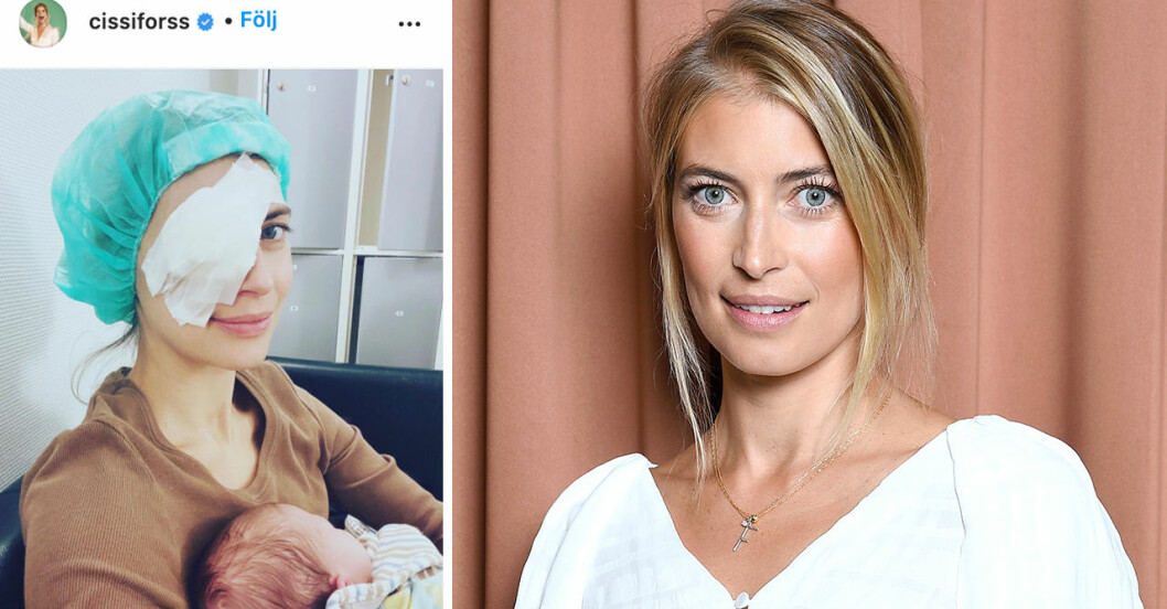 Cissi Forss operation i ansiktet – efter dottern födsel | Femina